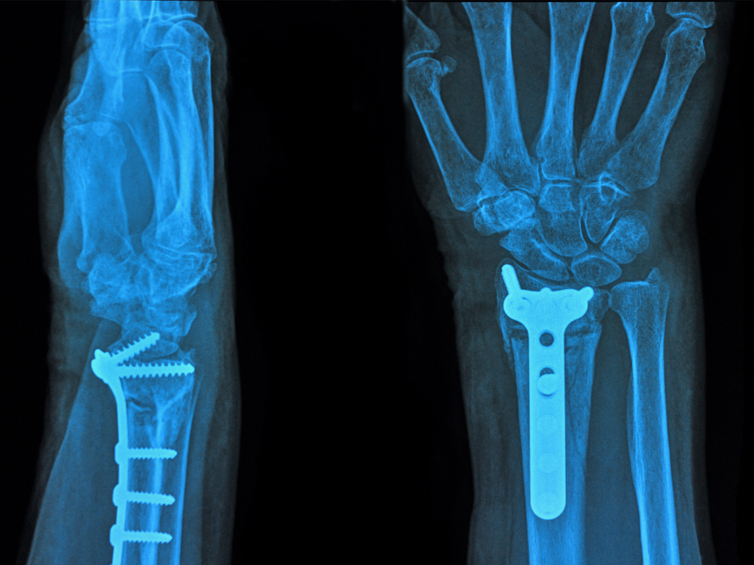 ASTM F1357 Articulating Total Wrist Implant Testing